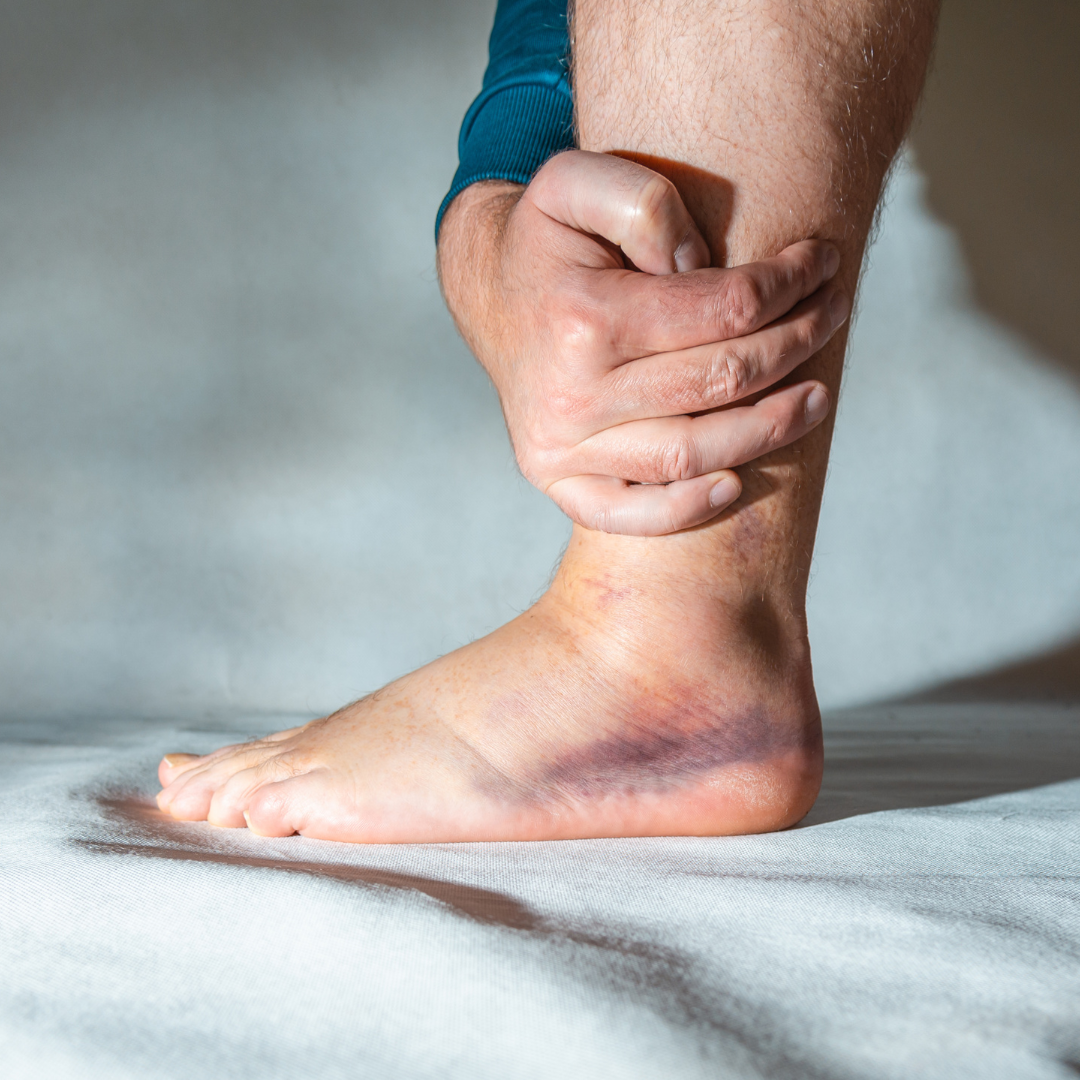 Acupuncture for a Sprained Ankle: A Natural Approach to Recovery ...